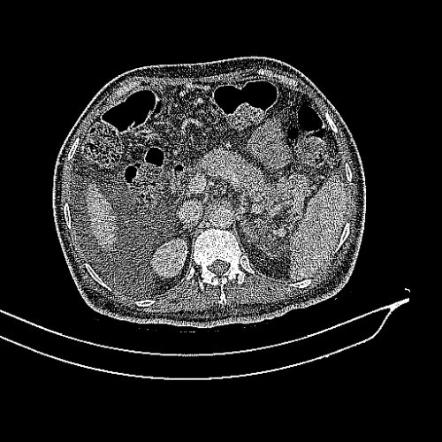 ct scan whole body - Abdomen and Pelvis CTs - embodi3D.com