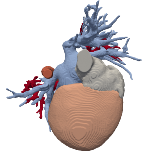 Model of human heart with aortic arch hypoplasia (AAH) generated from ...