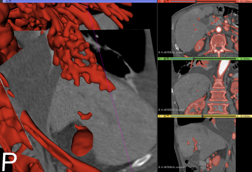 HEMIABDOMEN RIGTH - Abdomen and Pelvis CTs - embodi3D.com