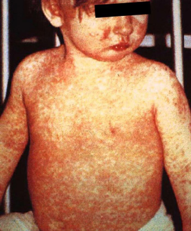 Measles Rash - Encyclopedia of Arkansas