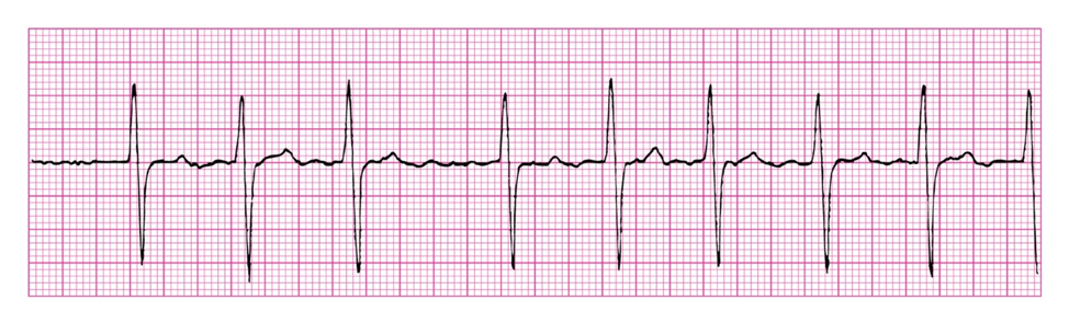EKG- SVT, Afib, Heart block, Pulmonary embolism – Markenzie Jean ...
