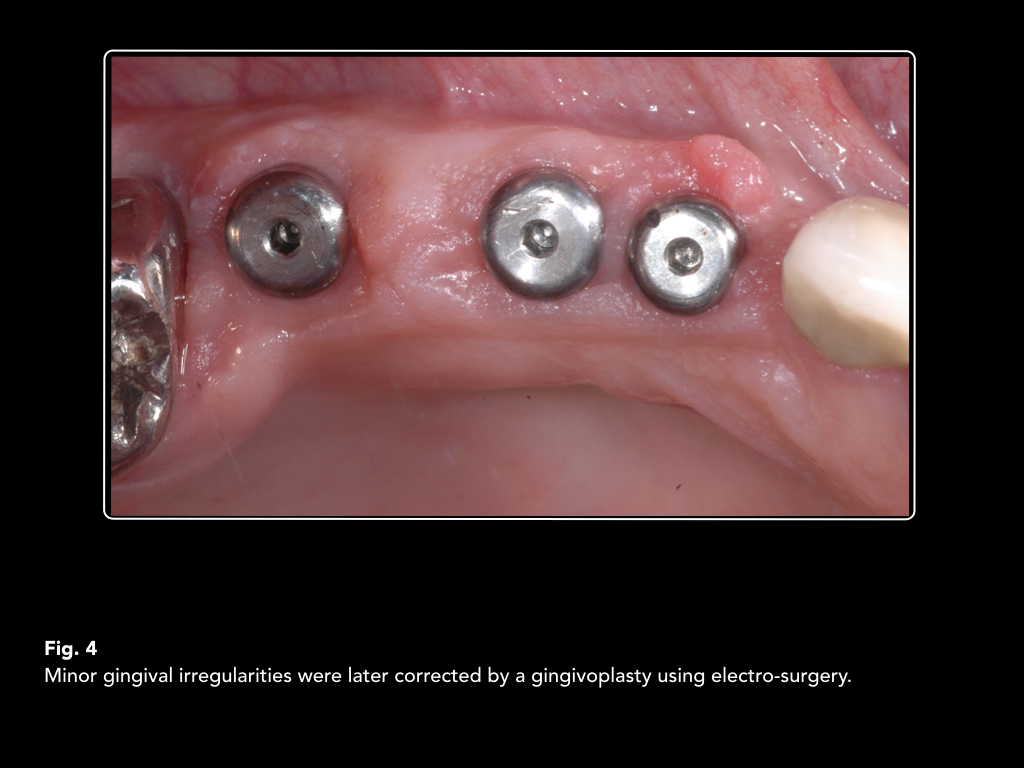 Implant-supported screw-retained splint - ImplantsConnect