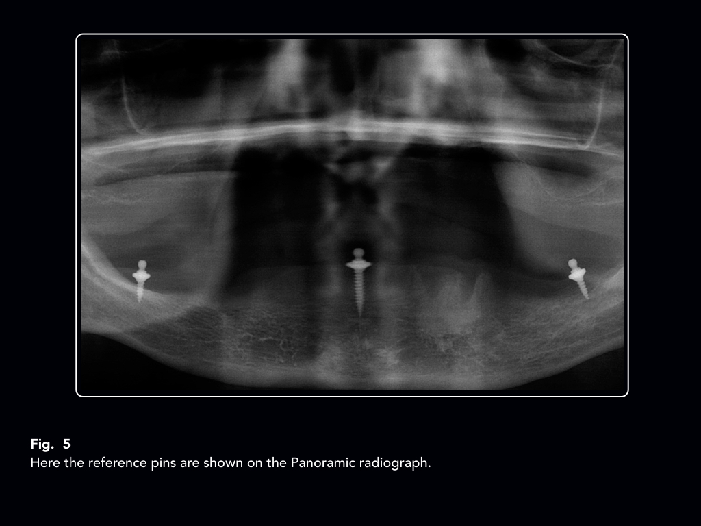 Implant navigation for treatment of severe bone atrophy in the ...
