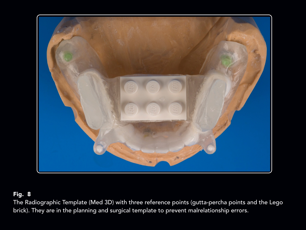 Implant navigation for treatment of severe bone atrophy in the ...