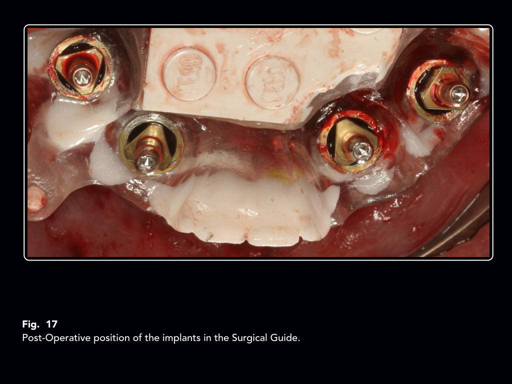 Implant navigation for treatment of severe bone atrophy in the ...