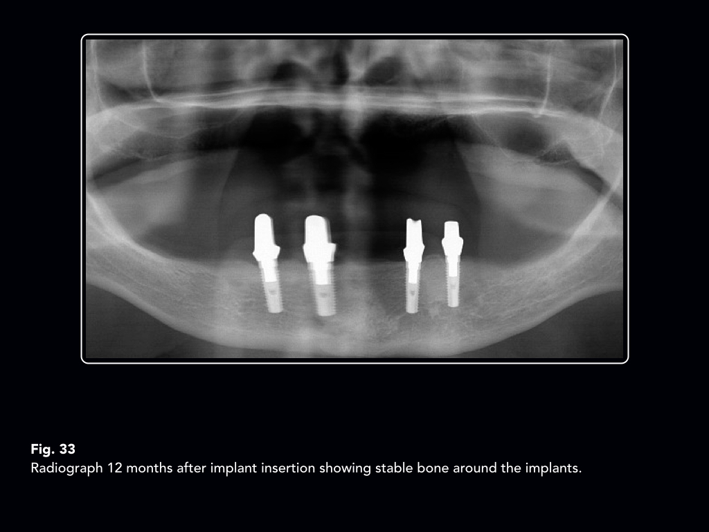 Implant navigation for treatment of severe bone atrophy in the ...