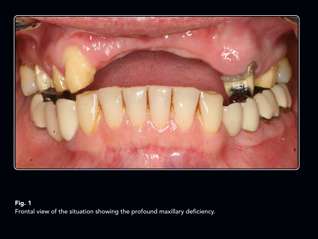 Warburton: Reconstruction of a severely atrophic maxilla after two ...