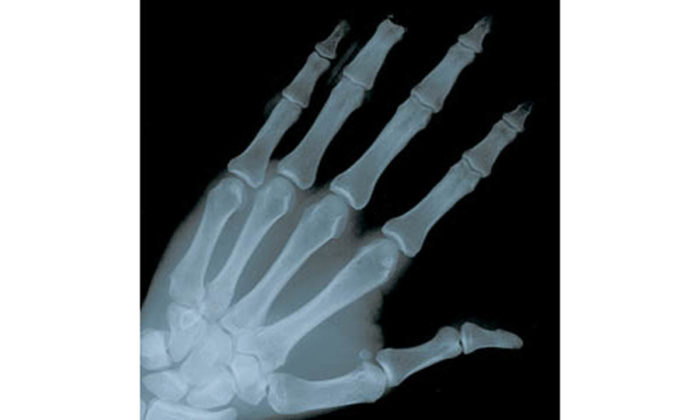 Losing a Fingertip - Fine Homebuilding