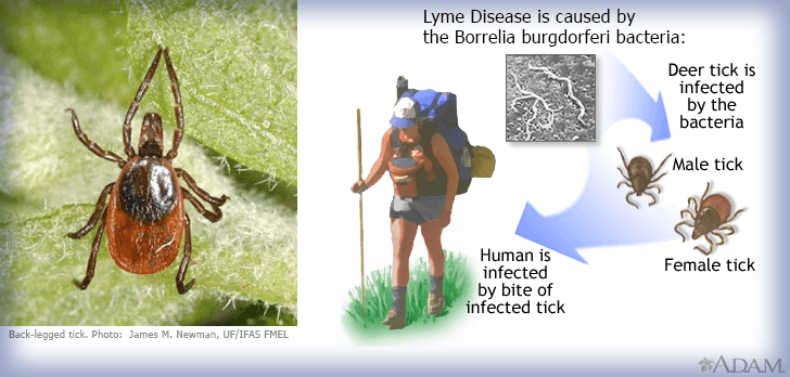 Lyme disease is on the rise in Florida, but experts don't know why ...