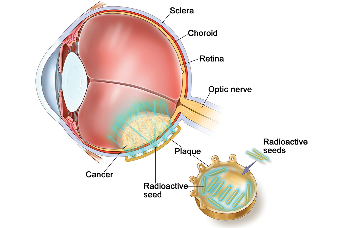 UF Health's plaque therapy spares healthy tissue in eye cancer patients ...