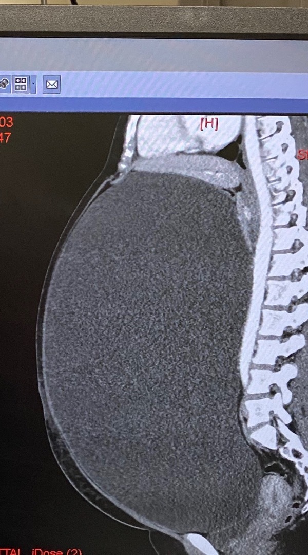 Sister’s Cyst Removal Surgery | Fundly