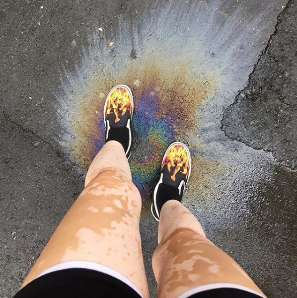 Instagram: fotos de modelo con vitiligo es tendencia | Fotos | Viral ...