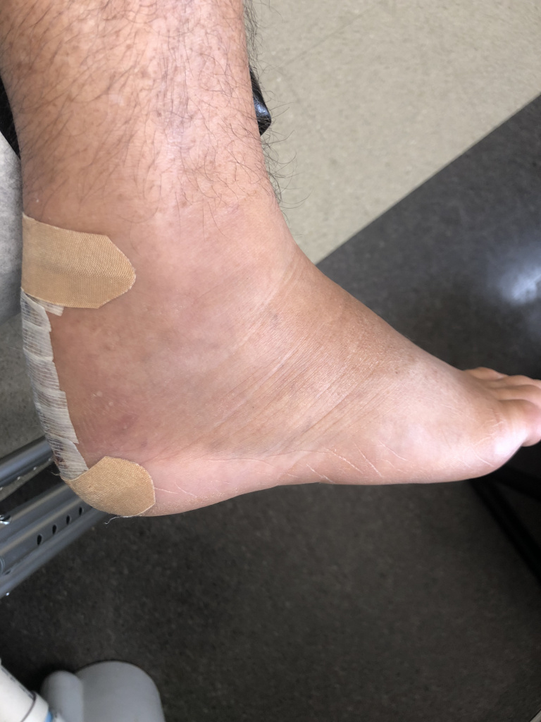 Journey on returning from Achilles surgery to my right foot....gnarly ...