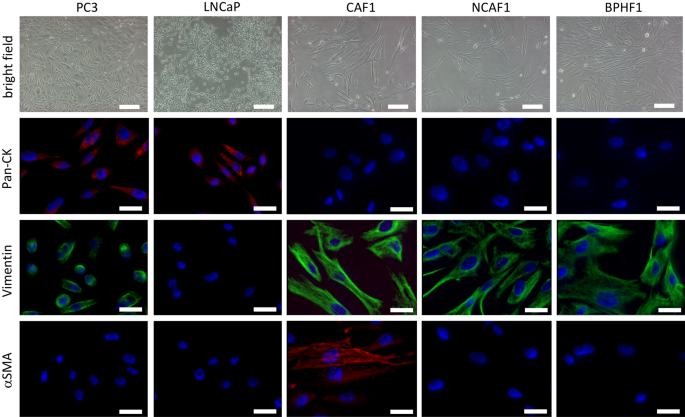 Cancer Associated Fibroblasts Stimulate Primary Tumor Growth And Metas