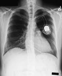 GC6ZA2K Cardiac pacemaker - Canadian Inventions HAG XIII (Traditional ...