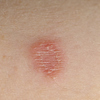 Red Ring Shaped Rash - Doctor answers on HealthTap