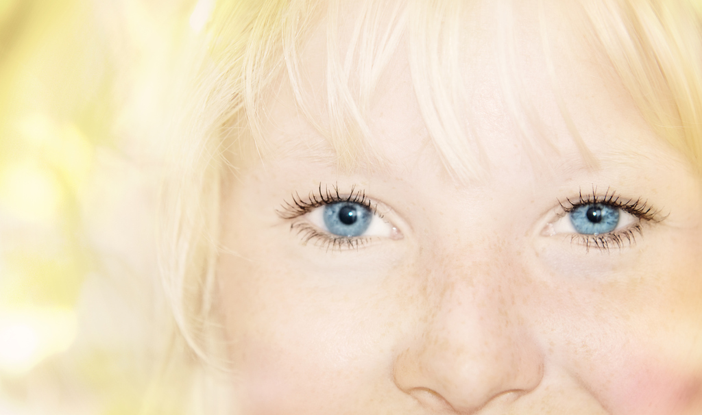 Albinismus Definition