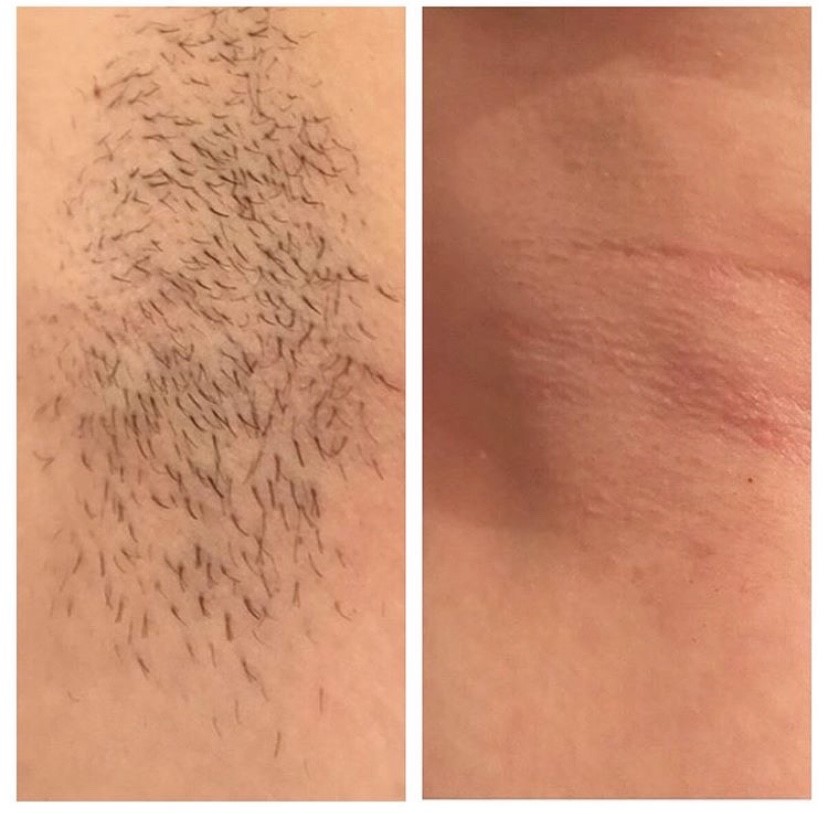 Turbulenz Sektor Aal Laser Armpit Removal Herr S d Netz Turbulenz Sektor Aal Laser Armpit Removal Herr S d Netz