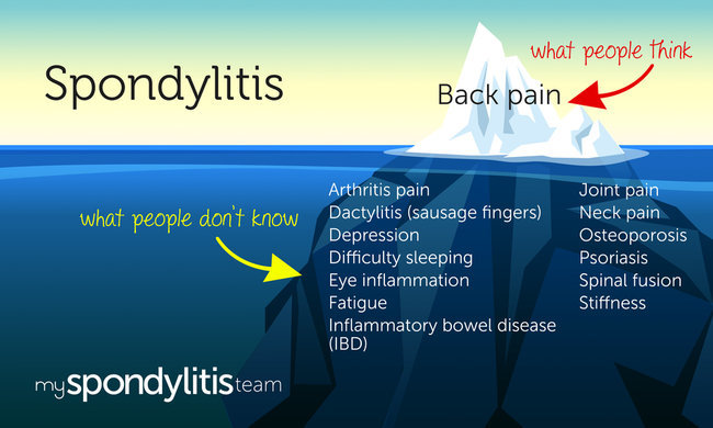 Spondylitis: What People Don’t See (Infographic) | MySpondylitisTeam