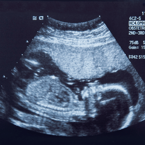 Non-Invasive Genetic Prenatal Testing – HudsonAlpha Institute for ...