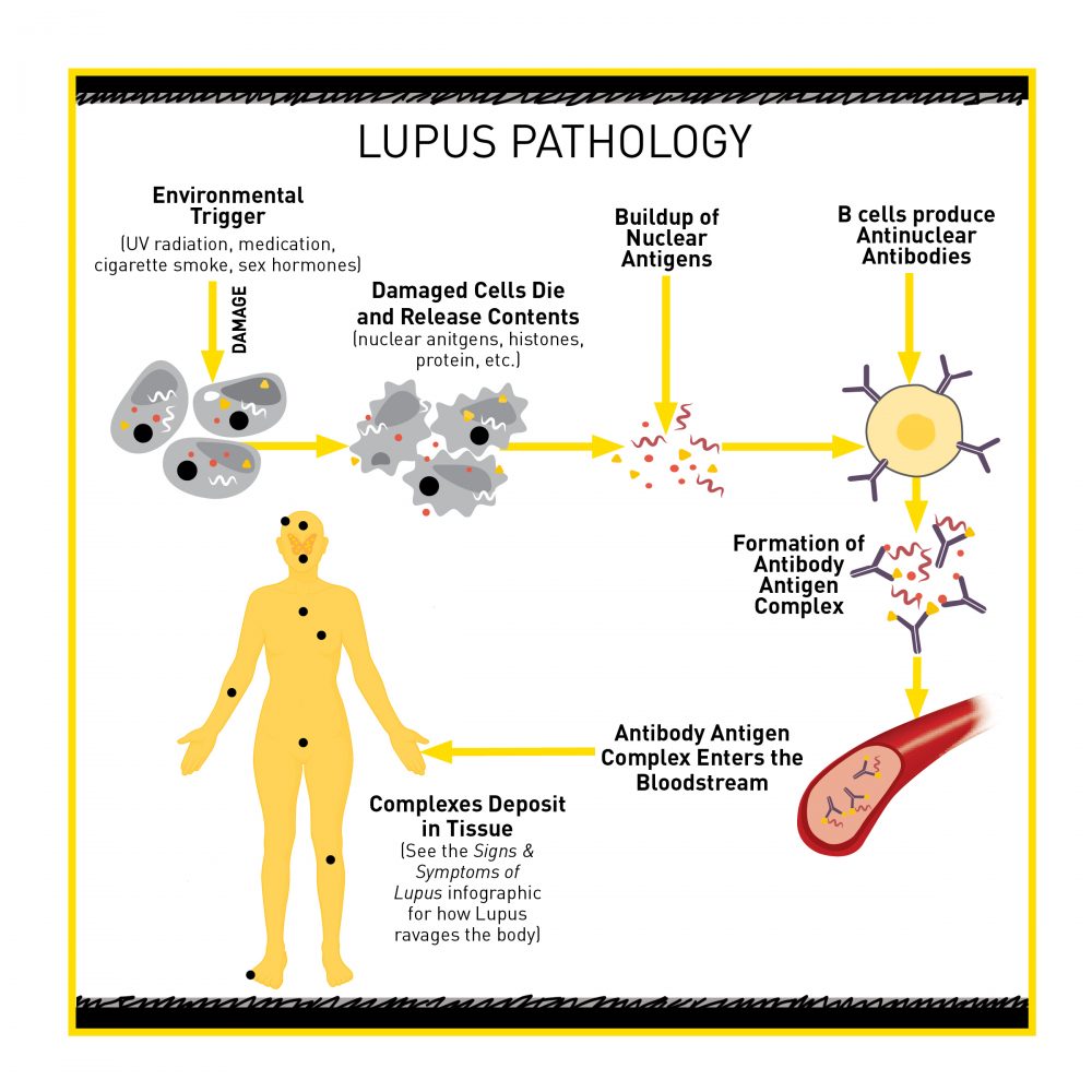 Lupus: Fighting an invisible monster – HudsonAlpha Institute for ...