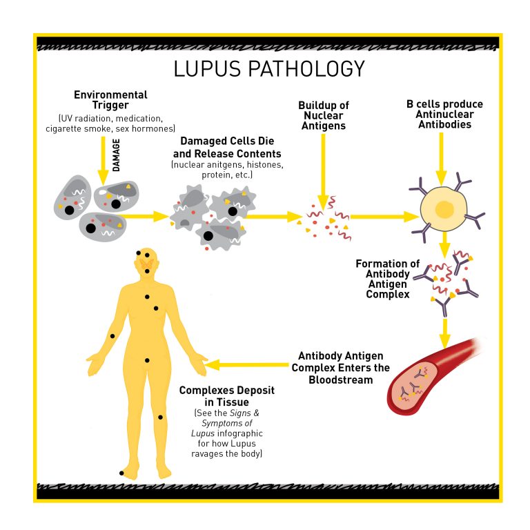 Lupus: Fighting an invisible monster – HudsonAlpha Institute for ...