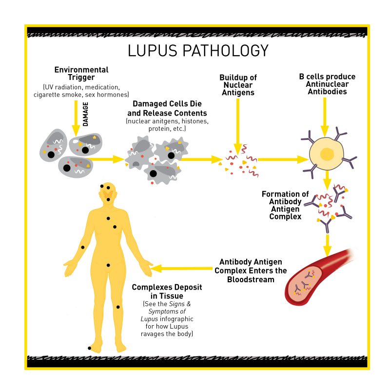 Lupus: Fighting an invisible monster – HudsonAlpha Institute for ...