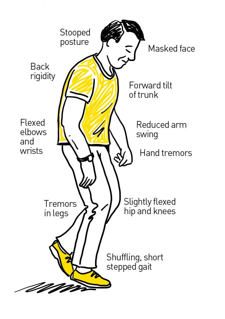 Parkinson’s Disease: exploring the science behind the symptoms ...