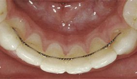 Gold Chain Lingual Retainer