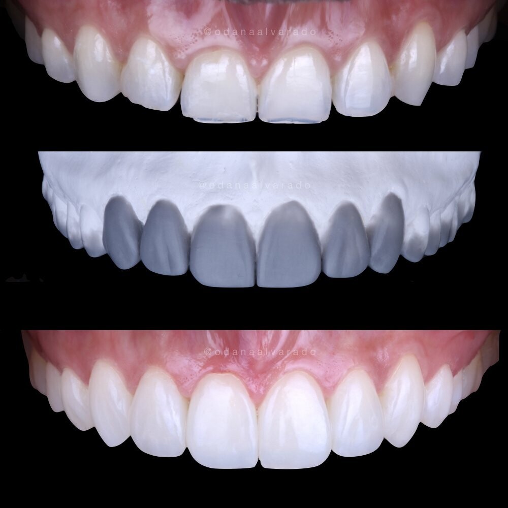 Curso DIY - Encerado Diagnóstico aplicado a la fase de planificación clínica en un paciente real