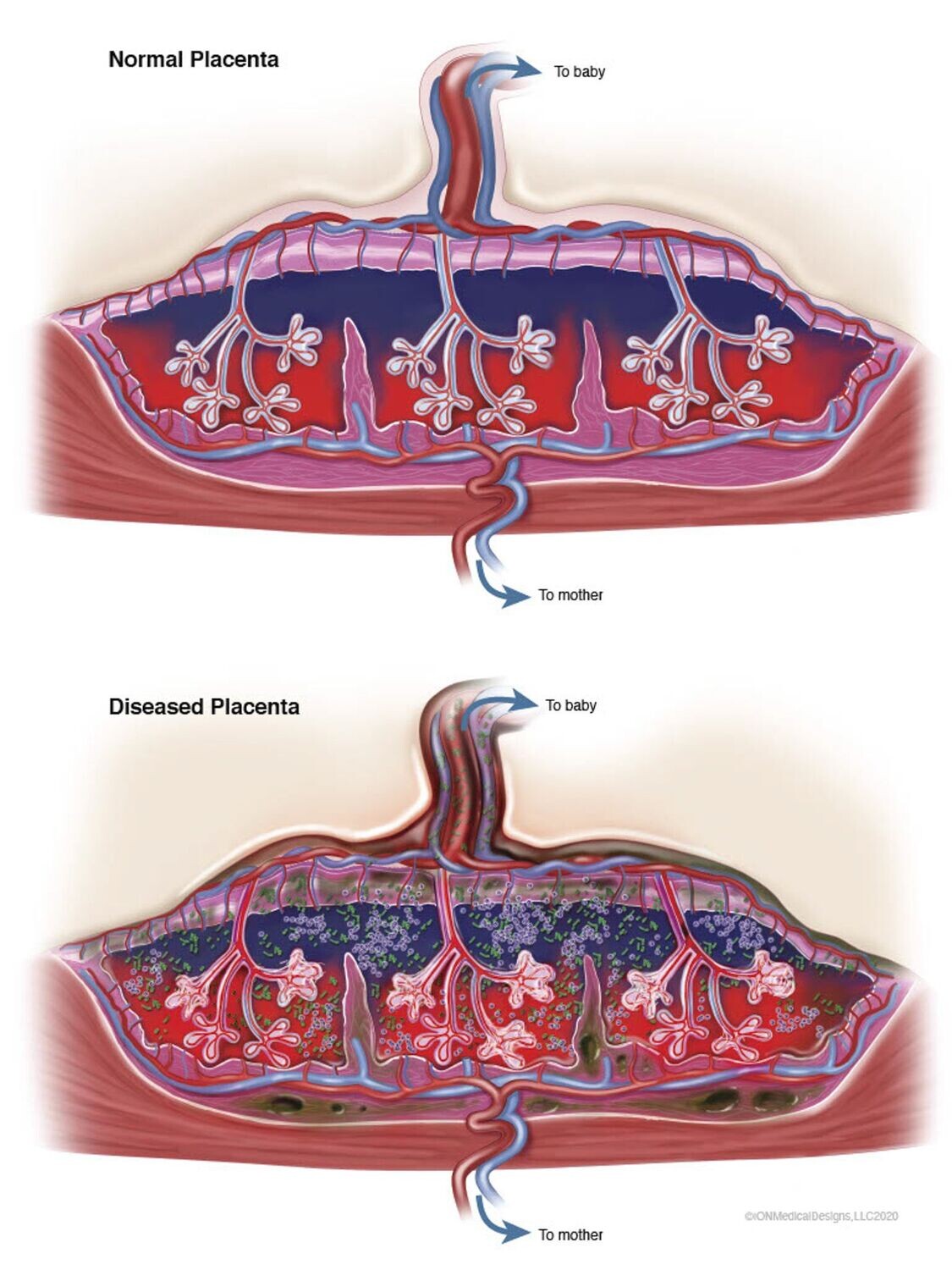 Normal and Diseased Placenta