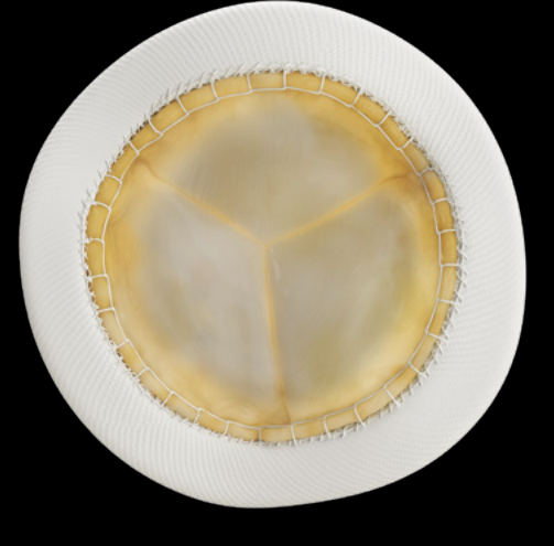 Hancock Bioprosthesis