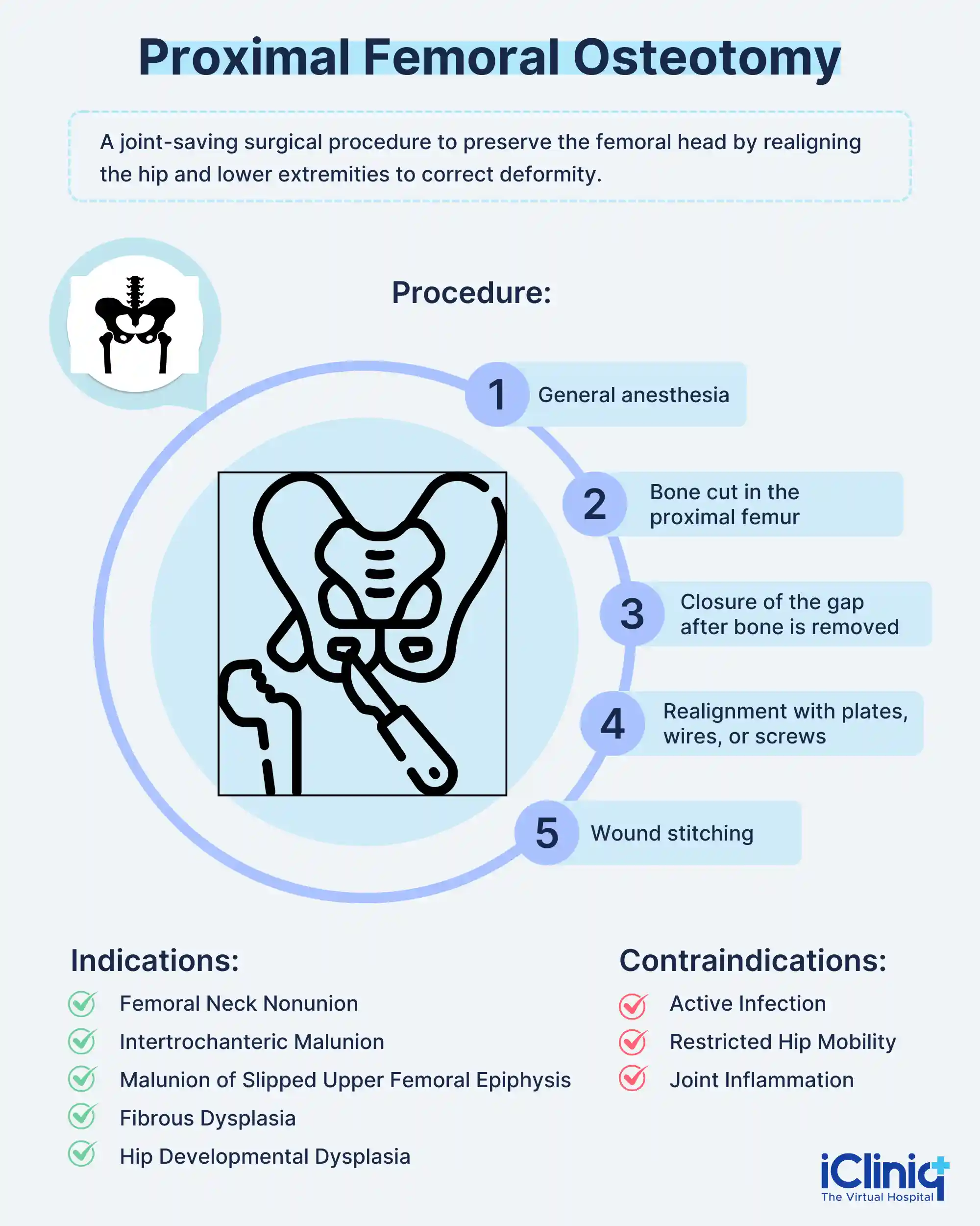What Is Proximal Femoral Osteotomy?