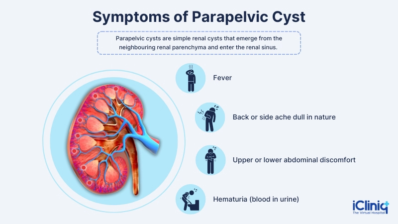 Types Of Kidney Cysts Renal Cysts Diagnosis And Treatment Polycystic