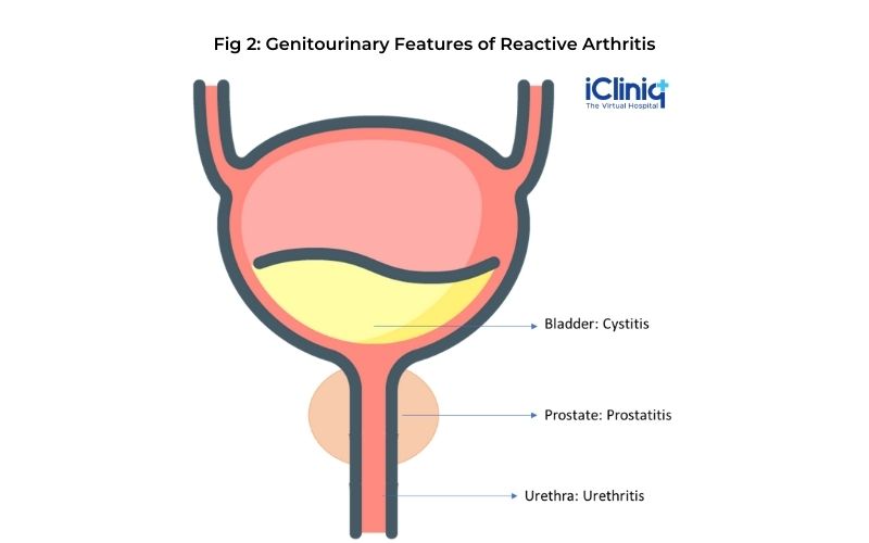 What Is Reactive Arthritis?