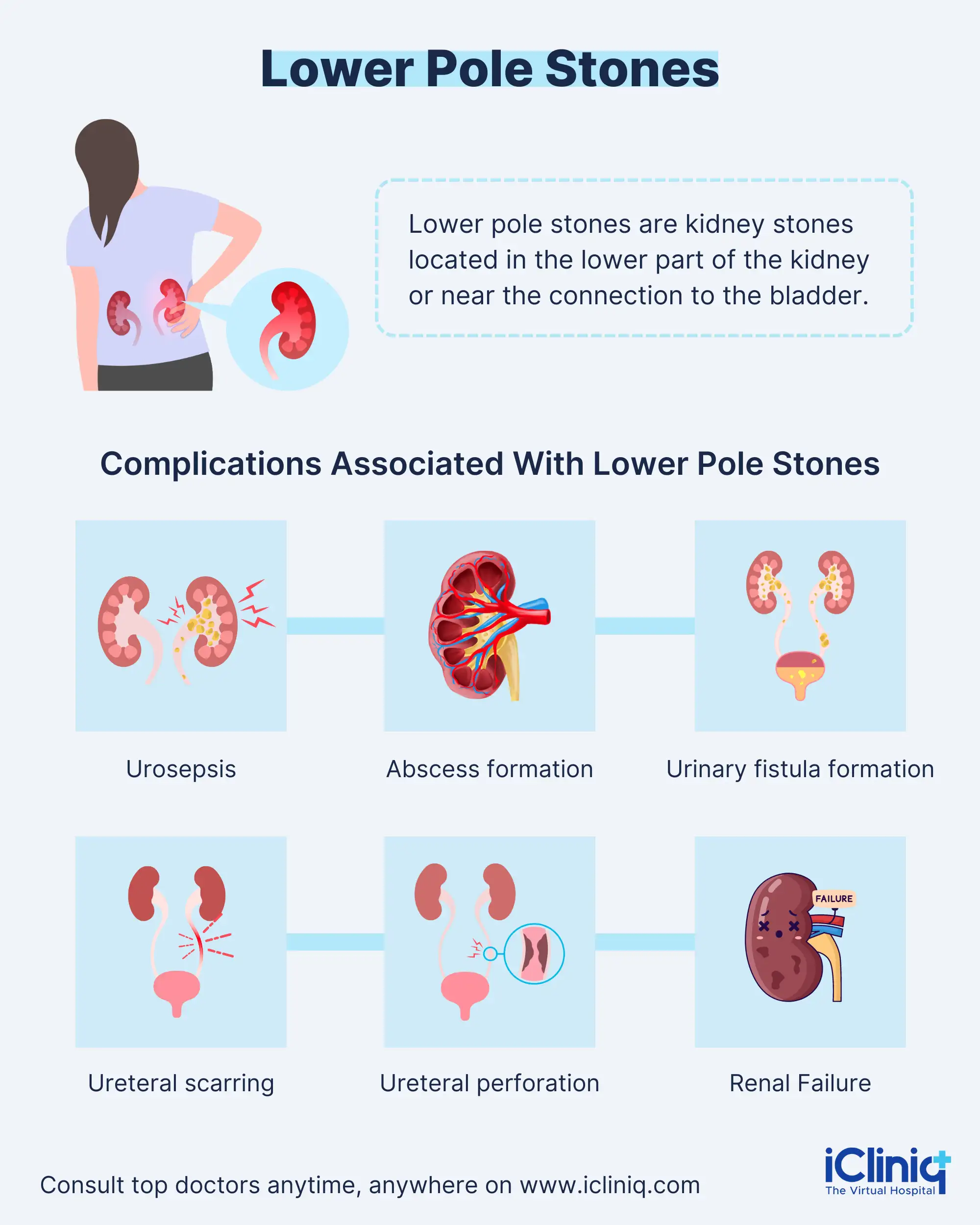 Upper And Lower Pole Kidney Stones On Pole Perspective Chapter: