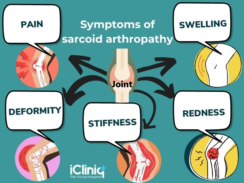 What Is Sarcoid Arthropathy?