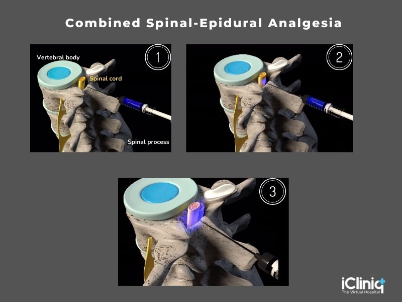 What Is Obstetrics Anesthesia?