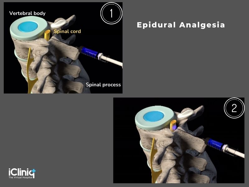 What Is Obstetrics Anesthesia?