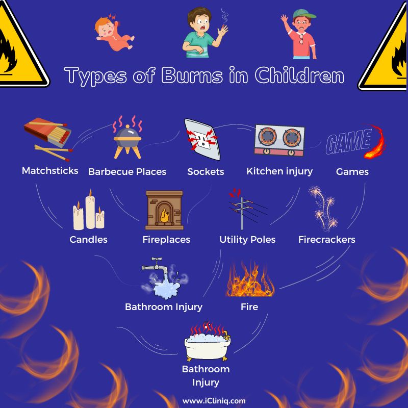 How to Treat Burns in Children?