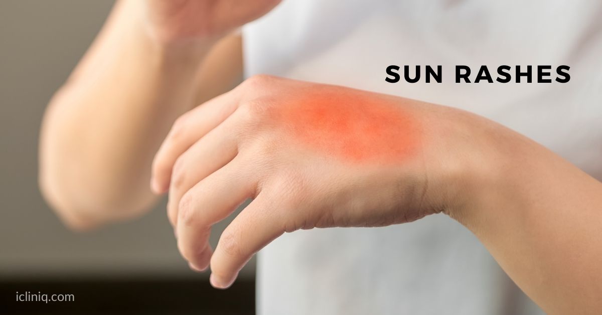 Know How Our iCliniq Doctor Helped a Patient With Sun Rashes
