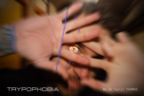 Trypophobia by Dr. Cyril Thomas Instant Download