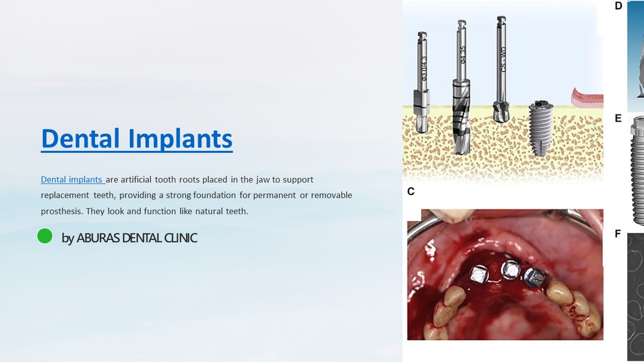 PPT – Dental-Implants (2) PowerPoint presentation | free to download - id: 98c9f4-YzFmM