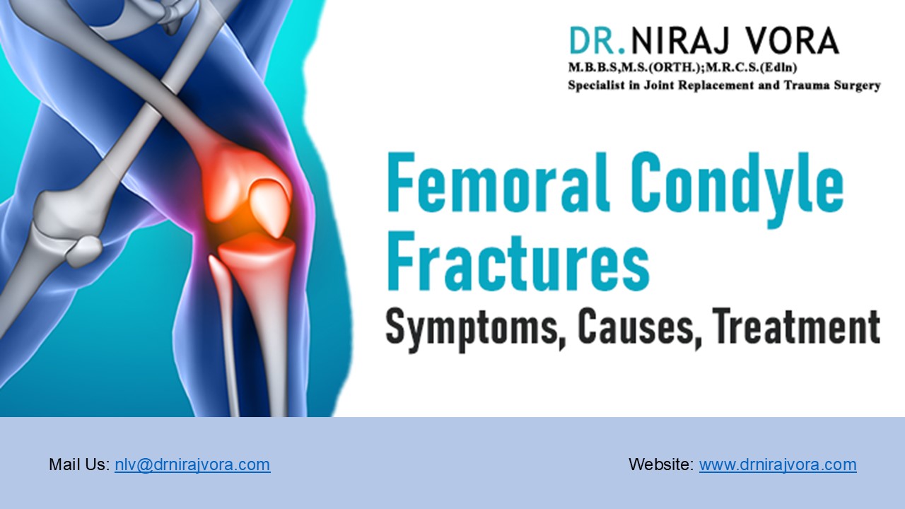 PPT – Femoral Condyle Fractures Symptoms Causes and Treatment | Dr ...