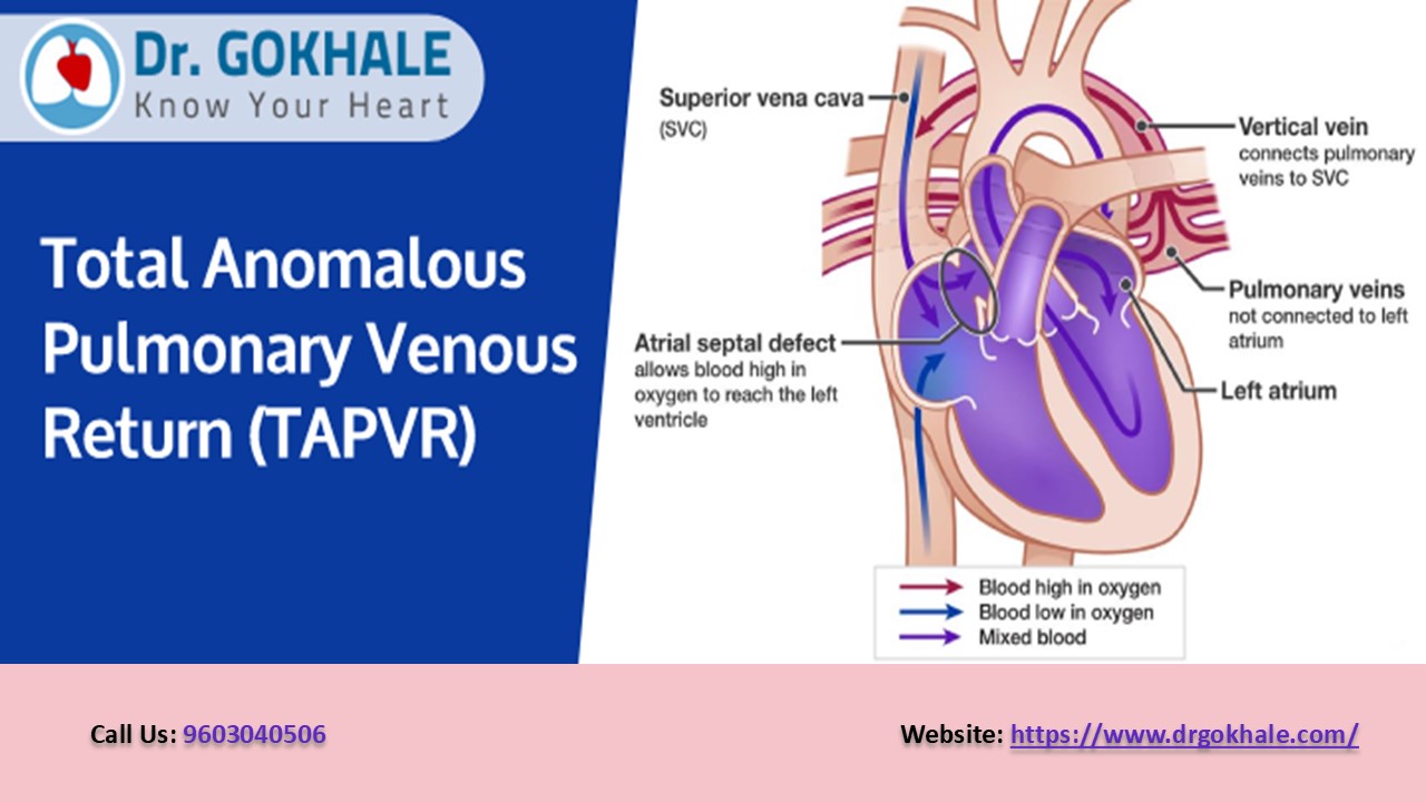 Total Anomalous Pulmonary Venous Return (TAPVR) | Dr Gokhale ...