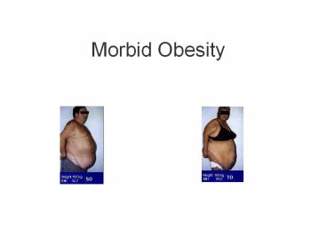 PPT – Morbid Obesity Morbid Obesity- What is it? The term morbid ...