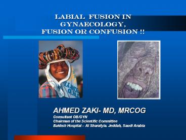 Labial fusion in gynaecology, Fusion oR confusion !! AHMED presentation ...