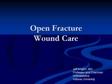 Open Fracture Wound Care Jeff Anglen, MD Professor and presentation ...