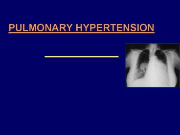 PPT – PULMONARY HYPERTENSION ??? ??? ?? ????? PowerPoint presentation ...