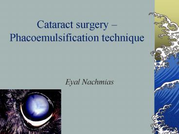PPT – Cataract surgery PowerPoint presentation | free to view - id ...